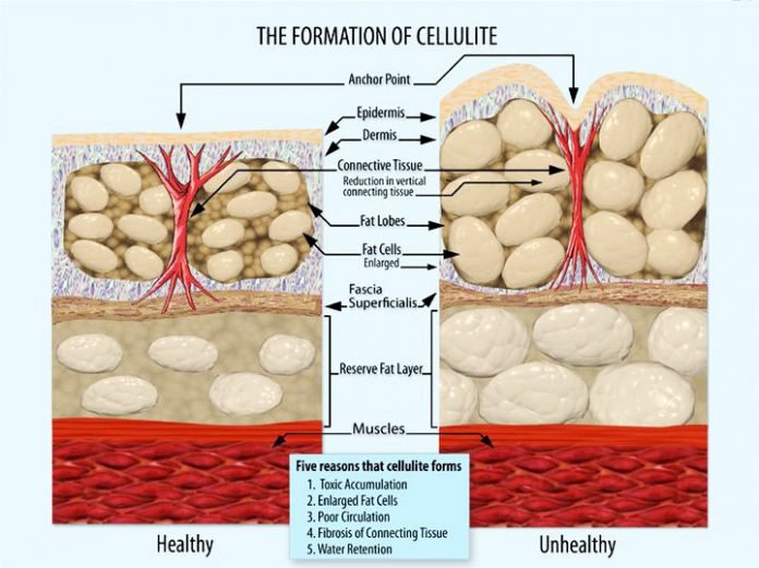 Home Remedies for Cellulite Reduction (Quickly & Naturally)