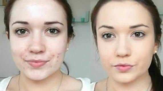 How to Remove Pimple Marks And Acne Marks From Face?