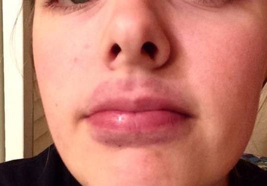 How to Get Rid of a Hickey Fast?