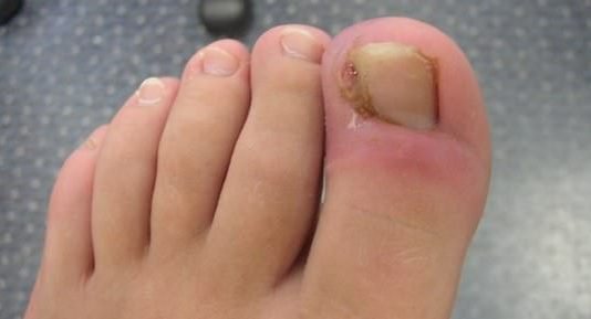 How to Get Rid of an Ingrown Toenail? (Remove Or Fix)