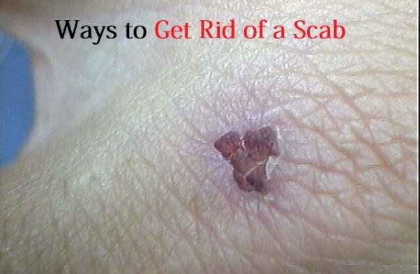 How to Get Rid of a Scab?